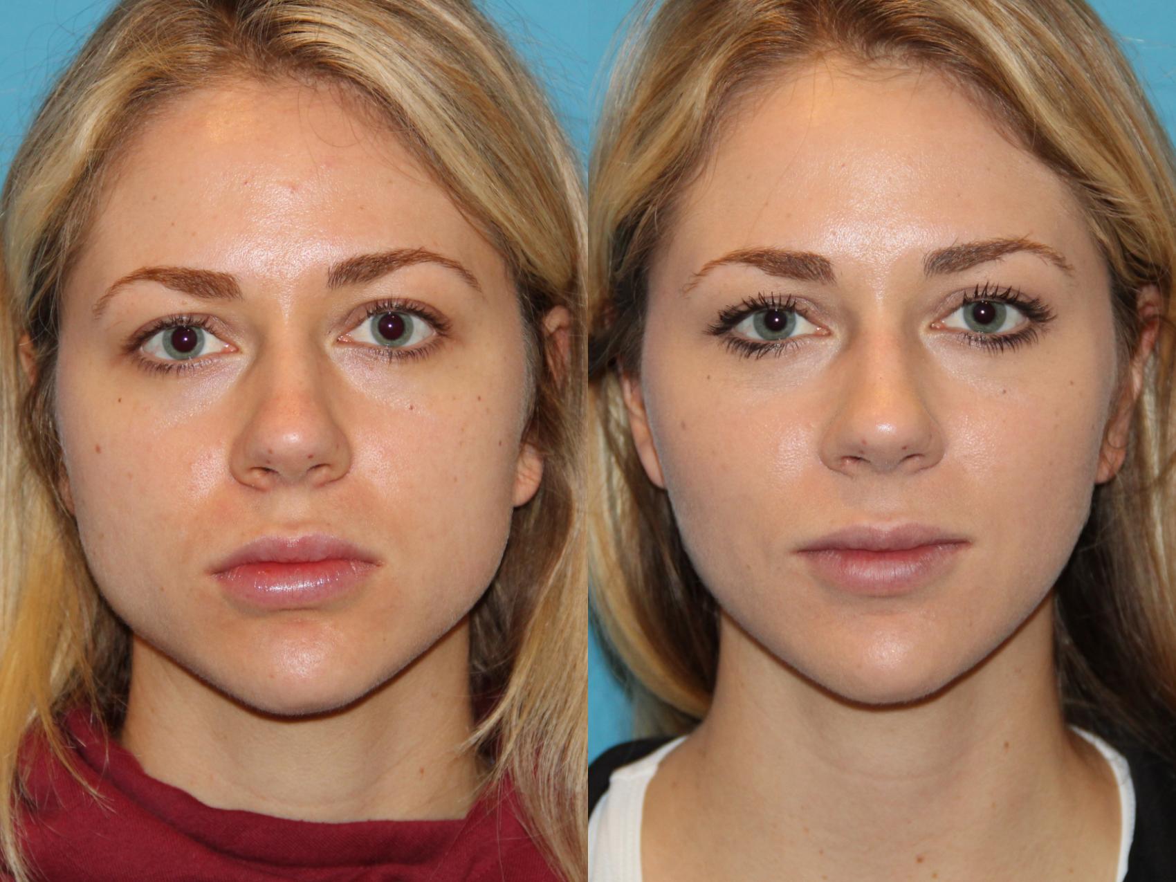 The Benefits of Jawline Botox for a More Sculpted and Defined Look